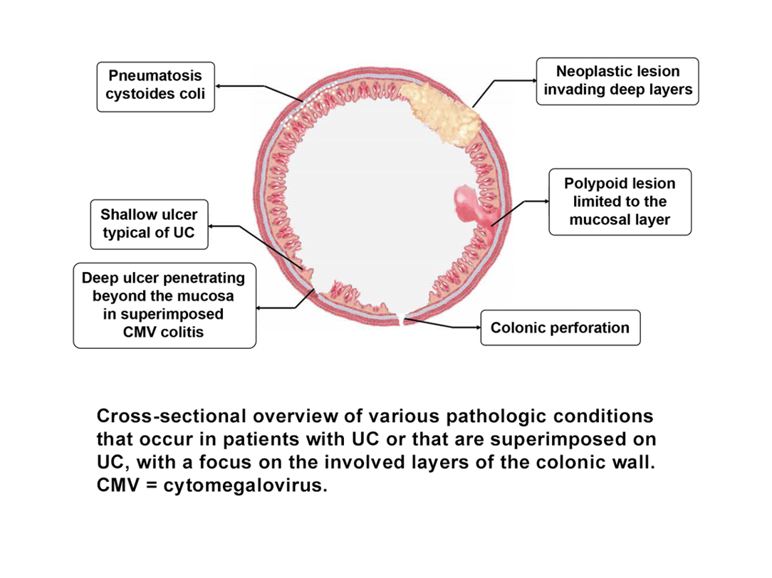 Is Enterography Underutilized in Diagnosing Ulcerative Colitis?