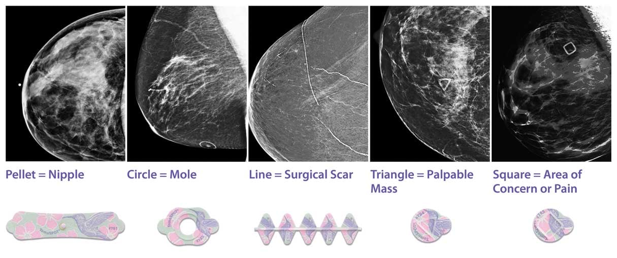 Putting the Brakes on Skipped Follow-up Exams in Mammography