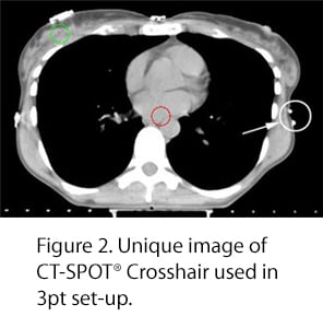 Finding the Zero Slice in CT Treatment Planning