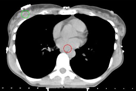 Our Best Practice with Crosshair Skin Markers for Three Point Set-Ups ...