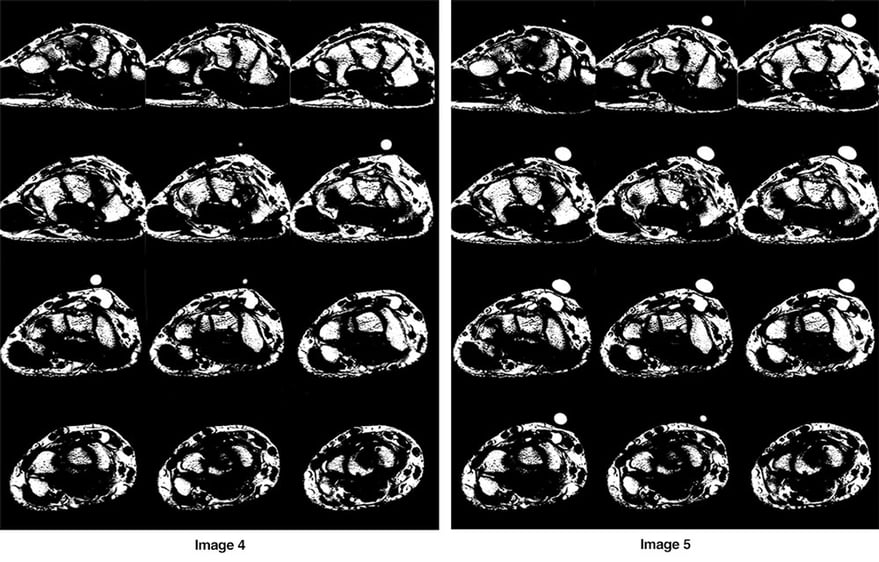 Skin Markers and Small Field of View Imaging in MRI