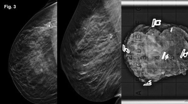 The Key Role Specimen Orientation Markers Play In Breast Conservation ...