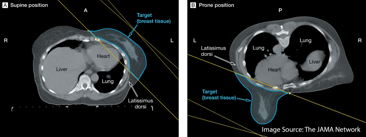 Supine vs. Prone Breast Treatment Planning