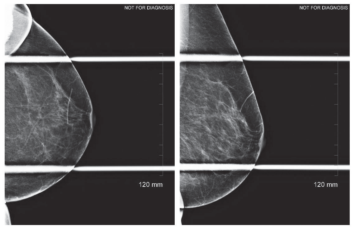 Why Marking Scars in Mammography Helps Image Interpretation